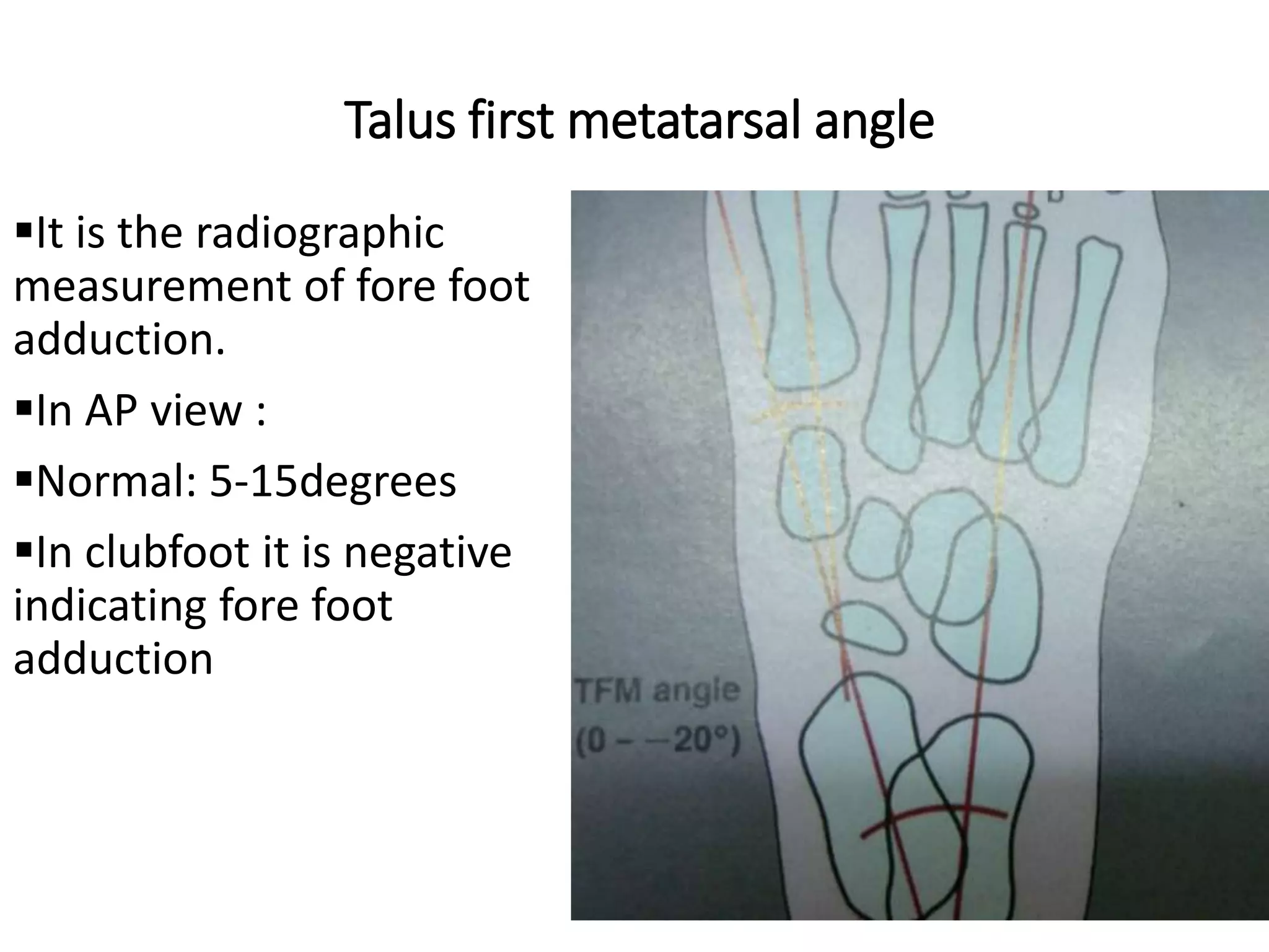 CTEV Imaging, Classification, Pirani scoring system, conservative ...