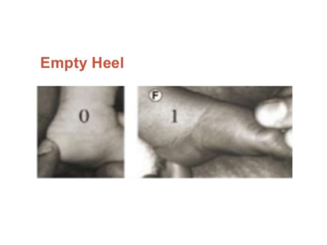 CTEV Imaging, Classification, Pirani scoring system, conservative ...