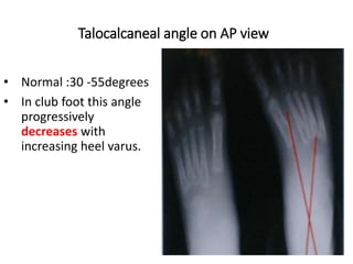 CTEV Imaging, Classification, Pirani scoring system, conservative ...