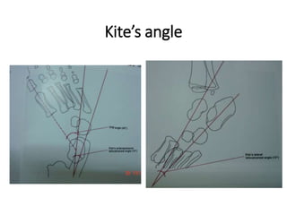 CTEV Imaging, Classification, Pirani scoring system, conservative ...