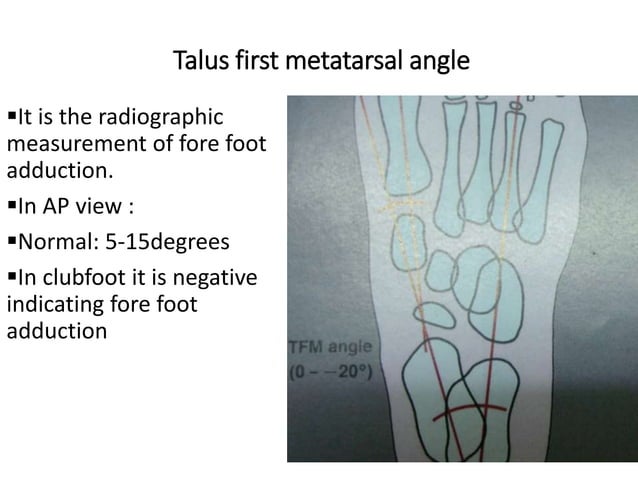 CTEV Imaging, Classification, Pirani scoring system, conservative ...