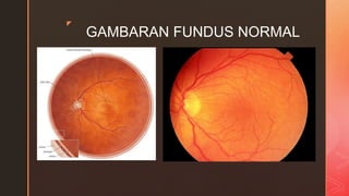 KKD SEGMENT POSTERIOR, ISIHARA.pptx