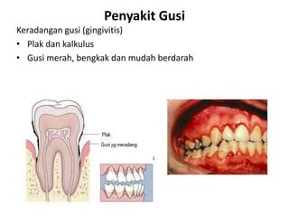 KESIHATAN PERGIGIAN & MULUT UNTUK KANAK-KANAK ISTIMEWA | PDF