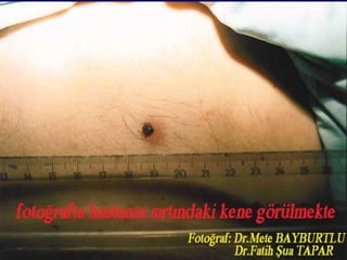 Kkka Epidemiyoloji | PPS