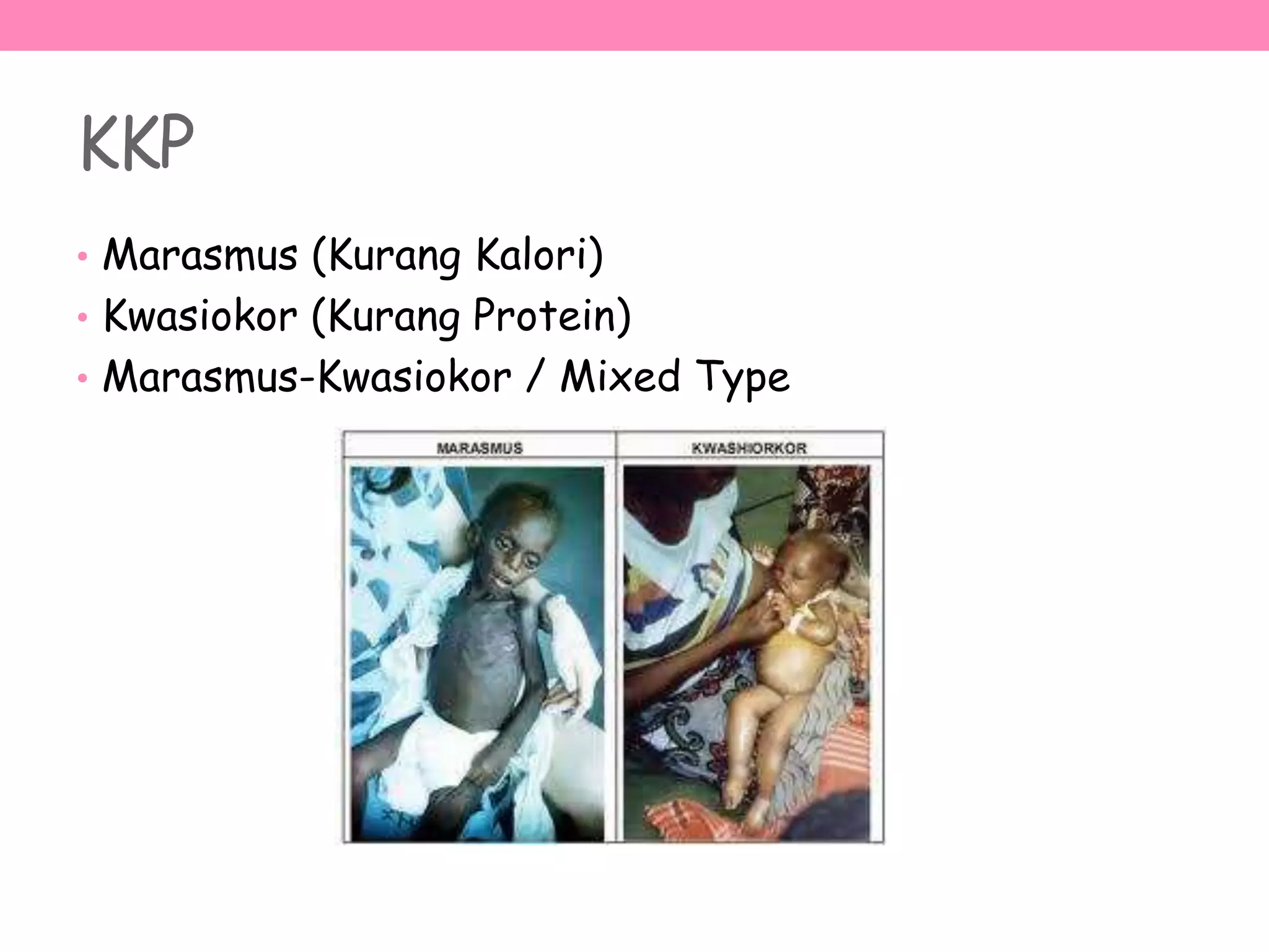 Kurang Kalori Protein | PPTX