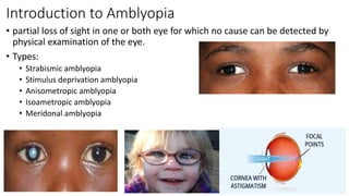 Ayurveda treatment and Eye exercises in Amblyopia | PPTX