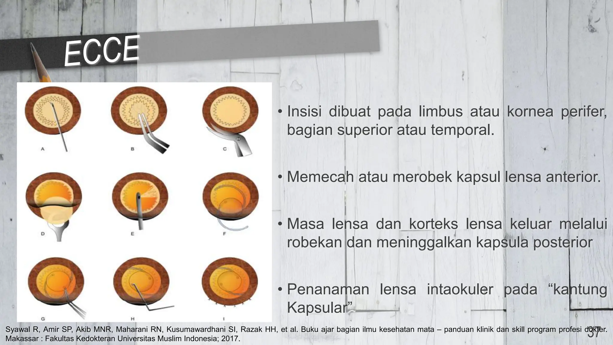 Klara-Katarak Matur.pptx