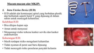 KLASIFIKASI_ALAT_KONTRASEPSINNFFFF[1].pptx