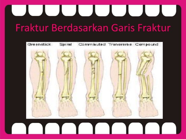 Klasifikasi frajtur berdasarkan garis fraktur