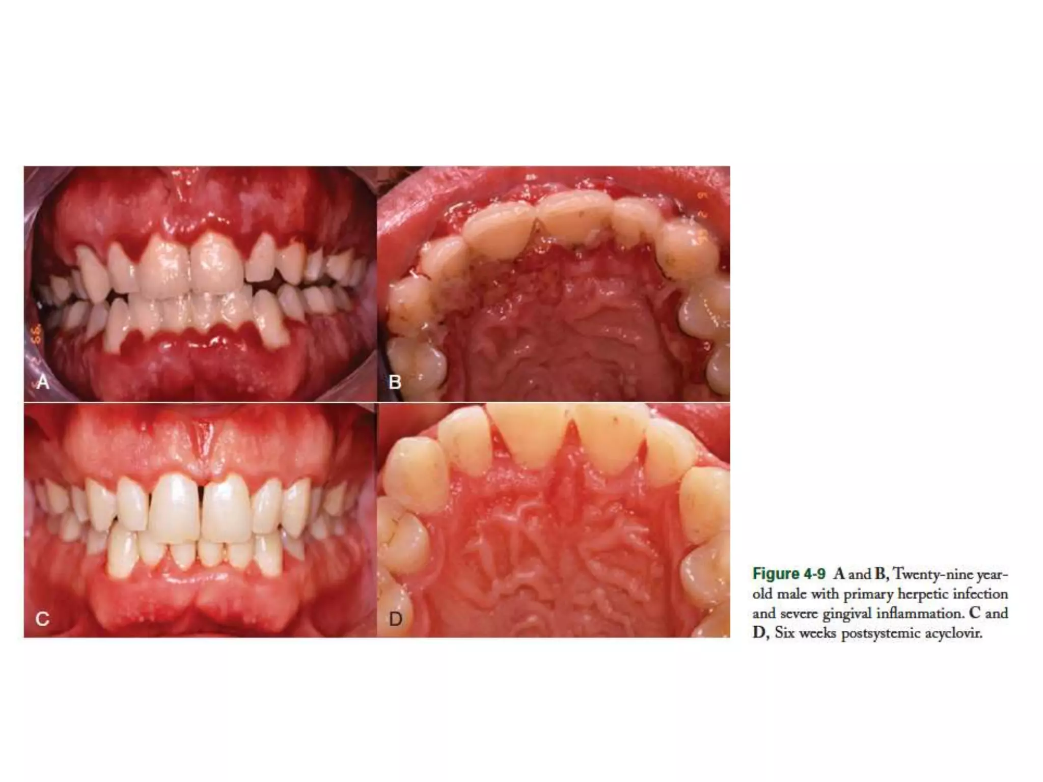 gingivitis classification | PPT