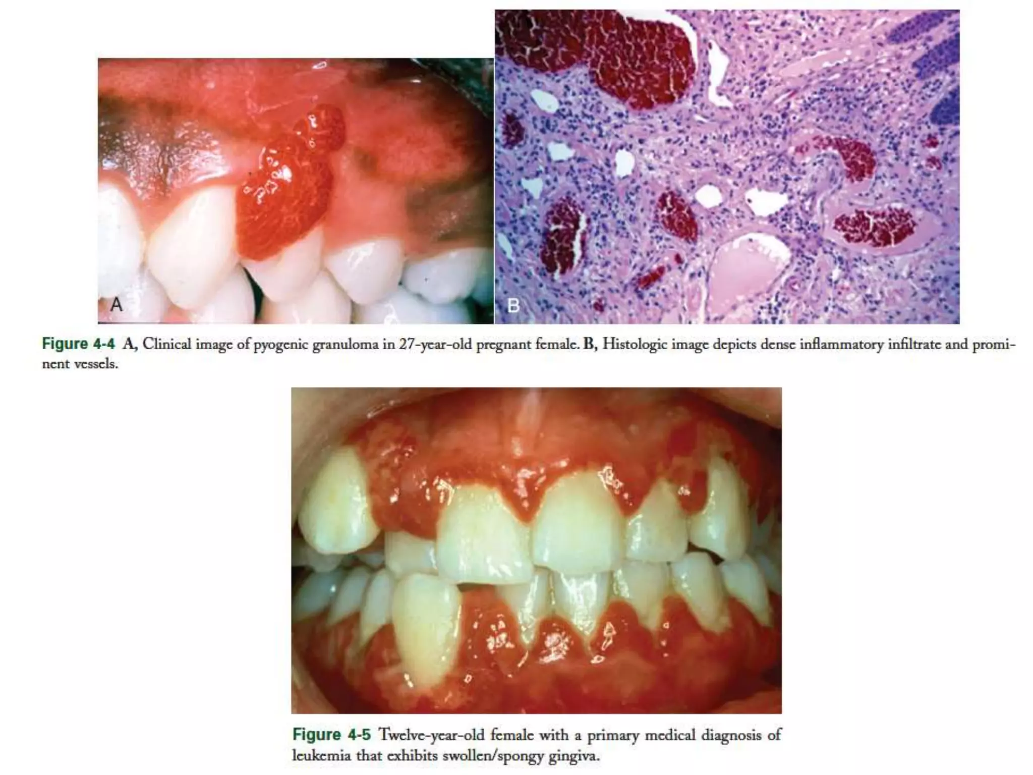 gingivitis classification | PPT