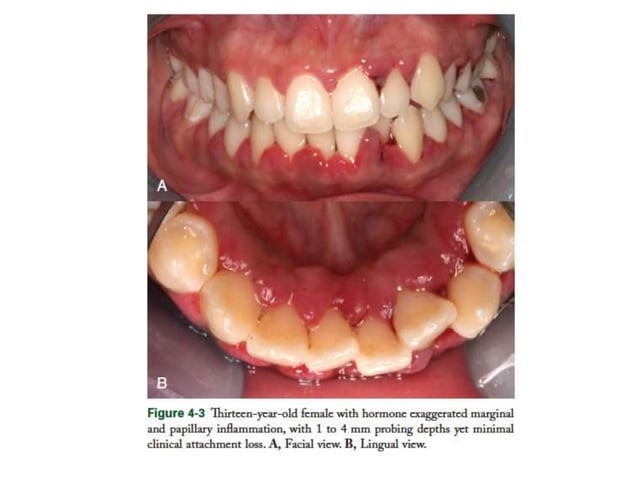 gingivitis classification | PPT