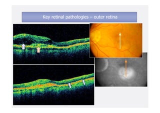 İnterpretation of optic coherence tomography images | PDF