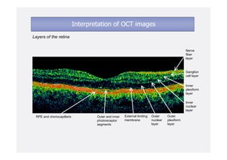 İnterpretation of optic coherence tomography images | PDF