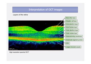 İnterpretation of optic coherence tomography images | PDF