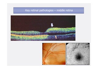 İnterpretation of optic coherence tomography images | PDF
