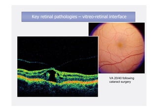 İnterpretation of optic coherence tomography images | PDF