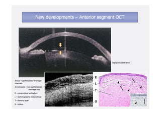 İnterpretation of optic coherence tomography images | PDF