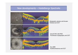 İnterpretation of optic coherence tomography images | PDF
