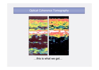 İnterpretation of optic coherence tomography images | PDF