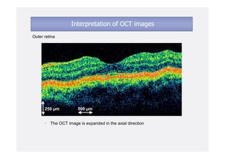 İnterpretation of optic coherence tomography images | PDF