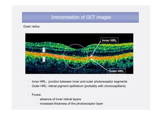 İnterpretation of optic coherence tomography images | PDF