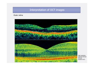 İnterpretation of optic coherence tomography images | PDF