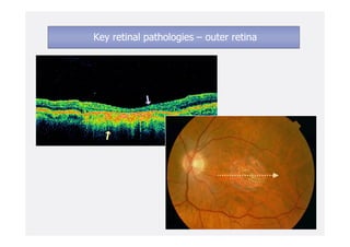 İnterpretation of optic coherence tomography images | PDF