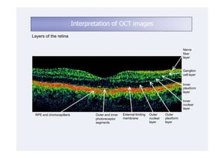 optical coherence tomography interprentation | PPTX | Eye and Vision ...