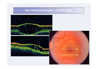 optical coherence tomography interprentation | PPTX | Eye and Vision ...