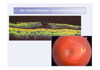optical coherence tomography interprentation | PPTX | Eye and Vision ...