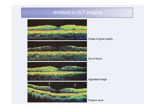 optical coherence tomography interprentation | PPTX | Eye and Vision ...