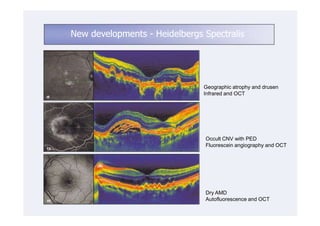 optical coherence tomography interprentation | PPTX | Eye and Vision ...