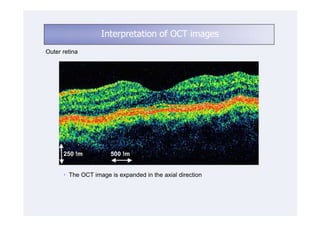 optical coherence tomography interprentation | PPTX | Eye and Vision ...