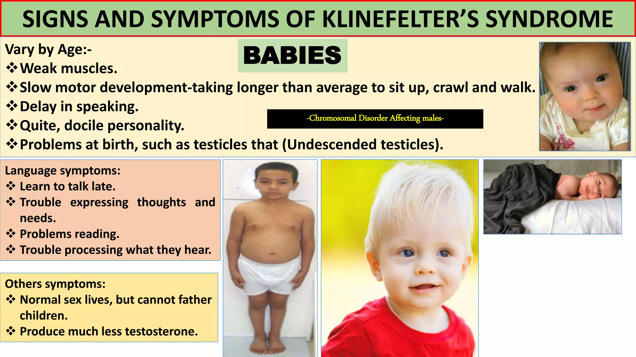 Klinefelter Syndrome | PPTX