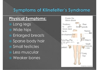 Klinefelter’s+Syndrome (1) (13 files merged).ppt
