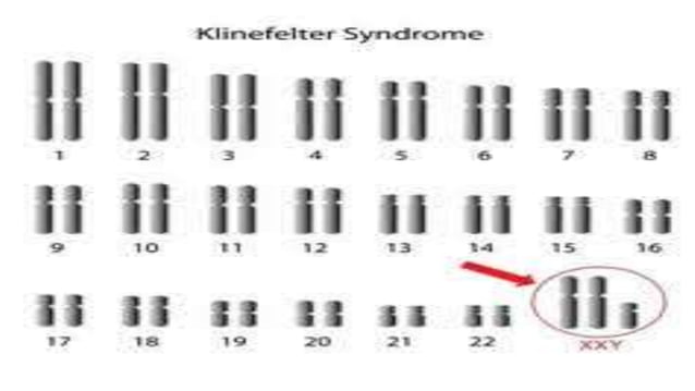 Klinefelter syndrome | PPTX | Infertility | Reproductive Health