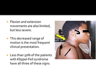 Klippel-Feil Syndrome | PPTX