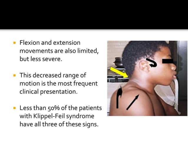 Klippel-Feil Syndrome | PPTX