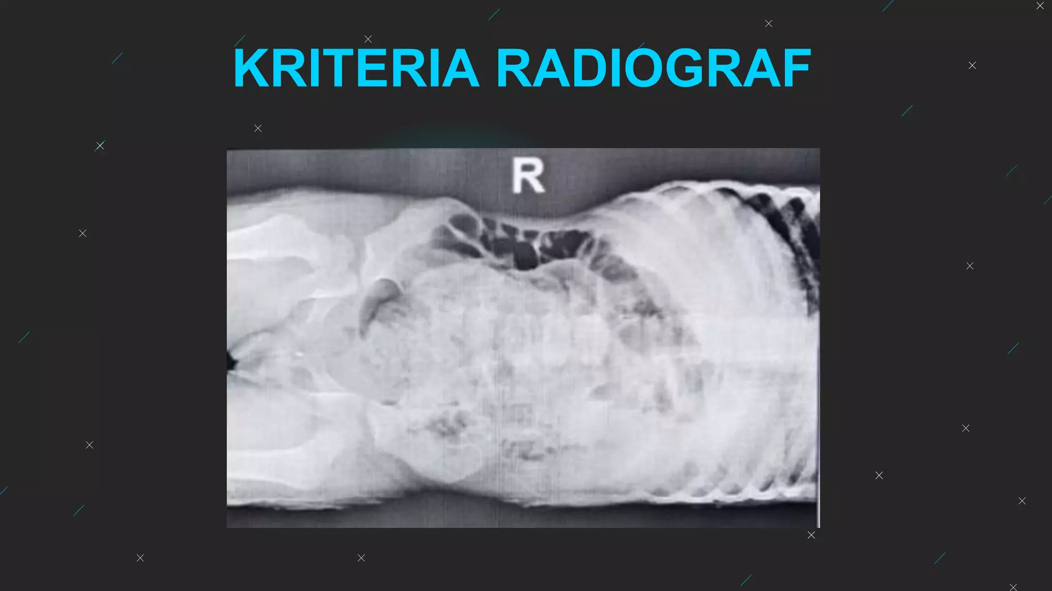 KLP 1 TR 3 COLON IN LOOP PEDIATRIC.pptx