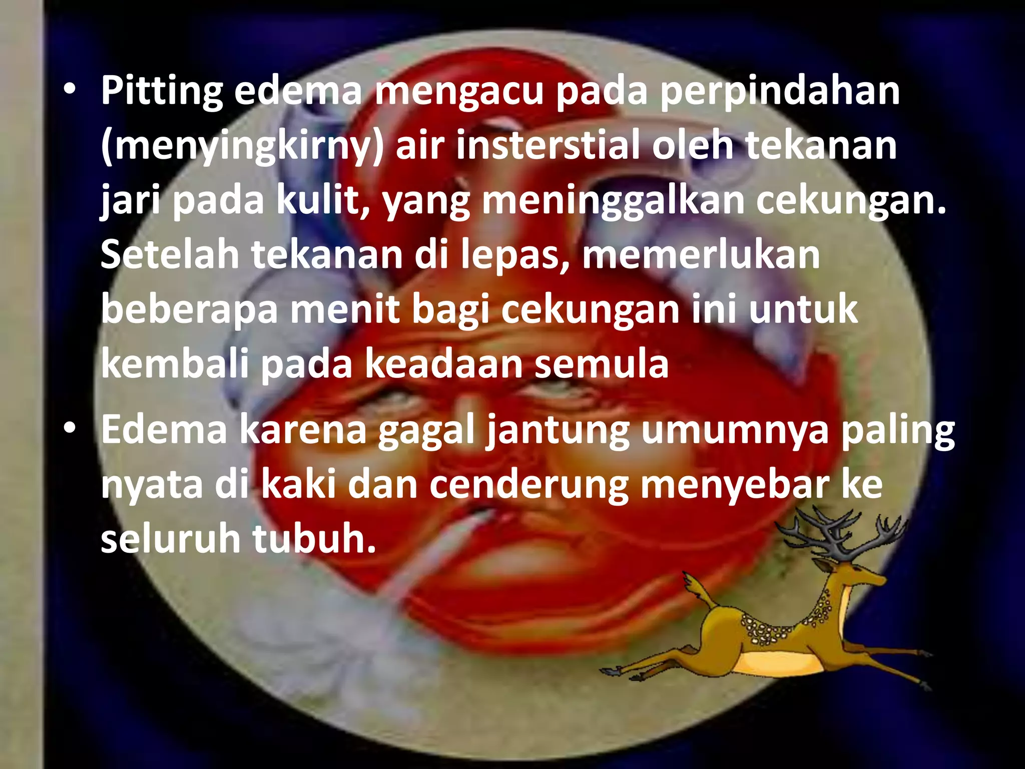 Pitting Edema. KMB 1. By Pangestu Chaesar S | PPTX