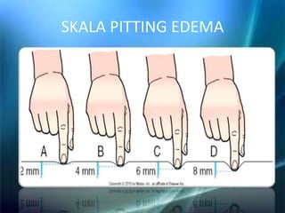 Pitting Edema. KMB 1. By Pangestu Chaesar S | PPTX