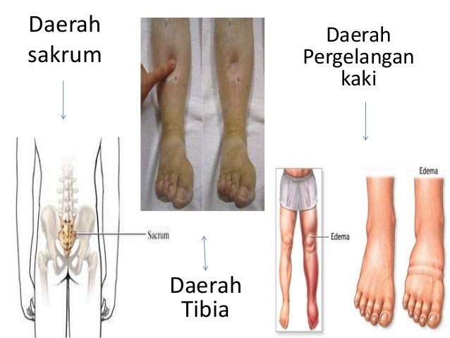 Pitting Edema. KMB 1. By Pangestu Chaesar S
