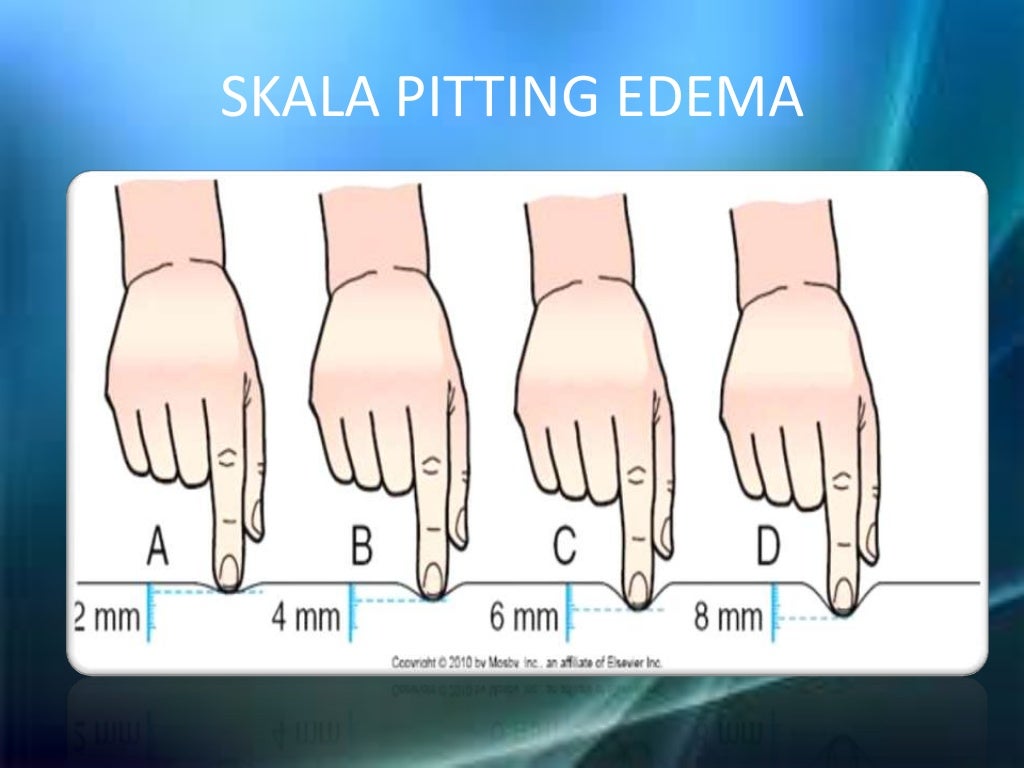 Pitting Edema. KMB 1. By Pangestu Chaesar S