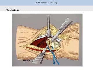 Reconstruction of scaphoid | PPT