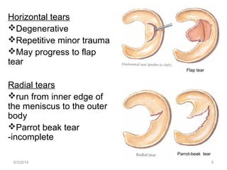Lesions of the Menisci | PPT | Death, Injury, or Military Conflict ...