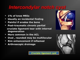 Intercondylar Notch Cyst