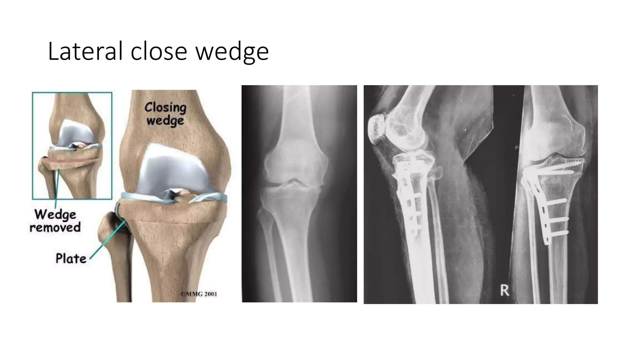 Knee Anatomy, approaches & Osteoarthritis | PPTX