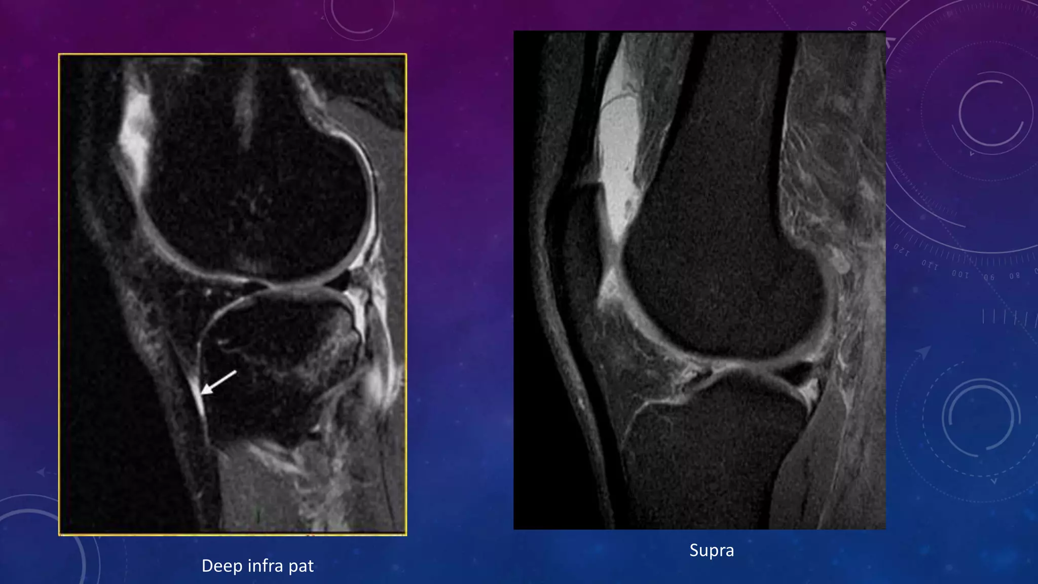 ACL anterior crucitae ligament anamtomy and physical therapy | PPTX
