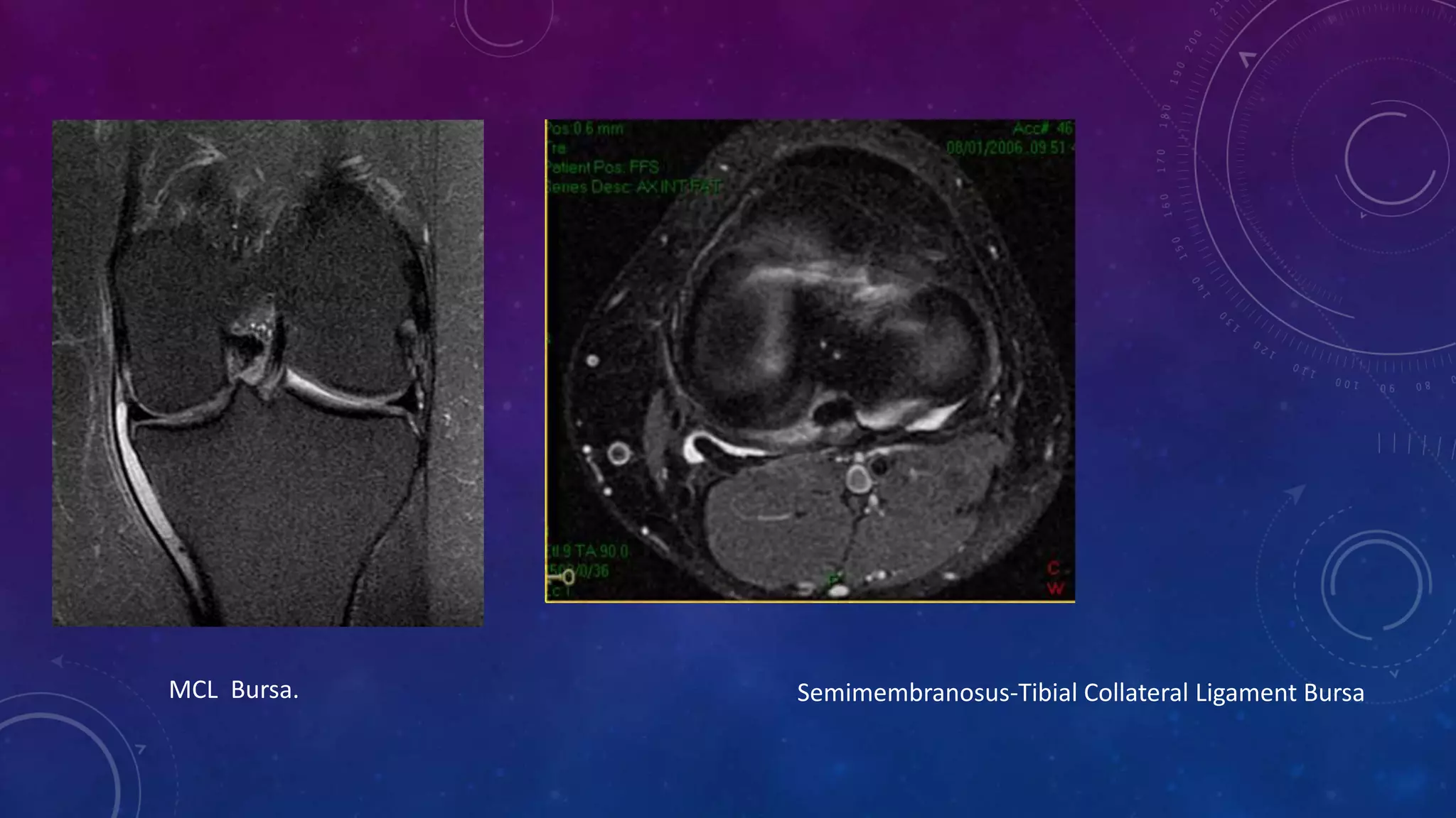 ACL anterior crucitae ligament anamtomy and physical therapy | PPTX